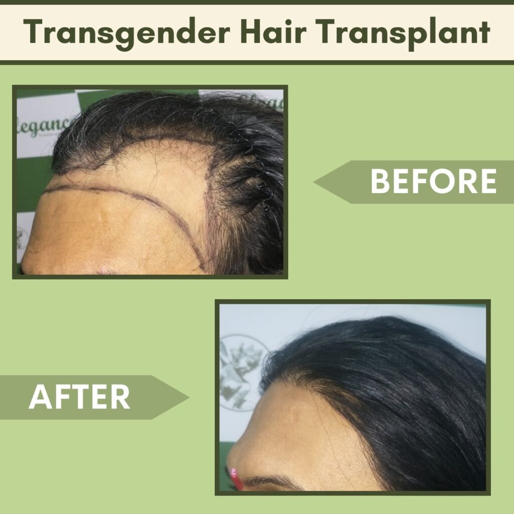 Transgender Hair Transplant – Elegance Podcast